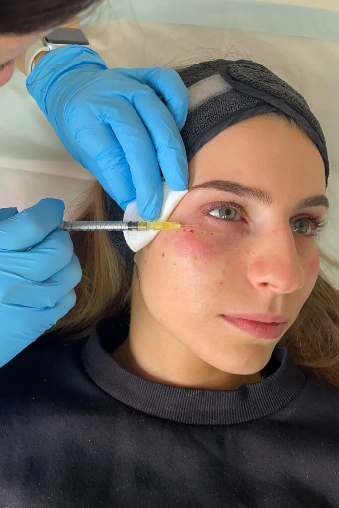 Best under eye treatment in Phagwara, Punjab- INDIA